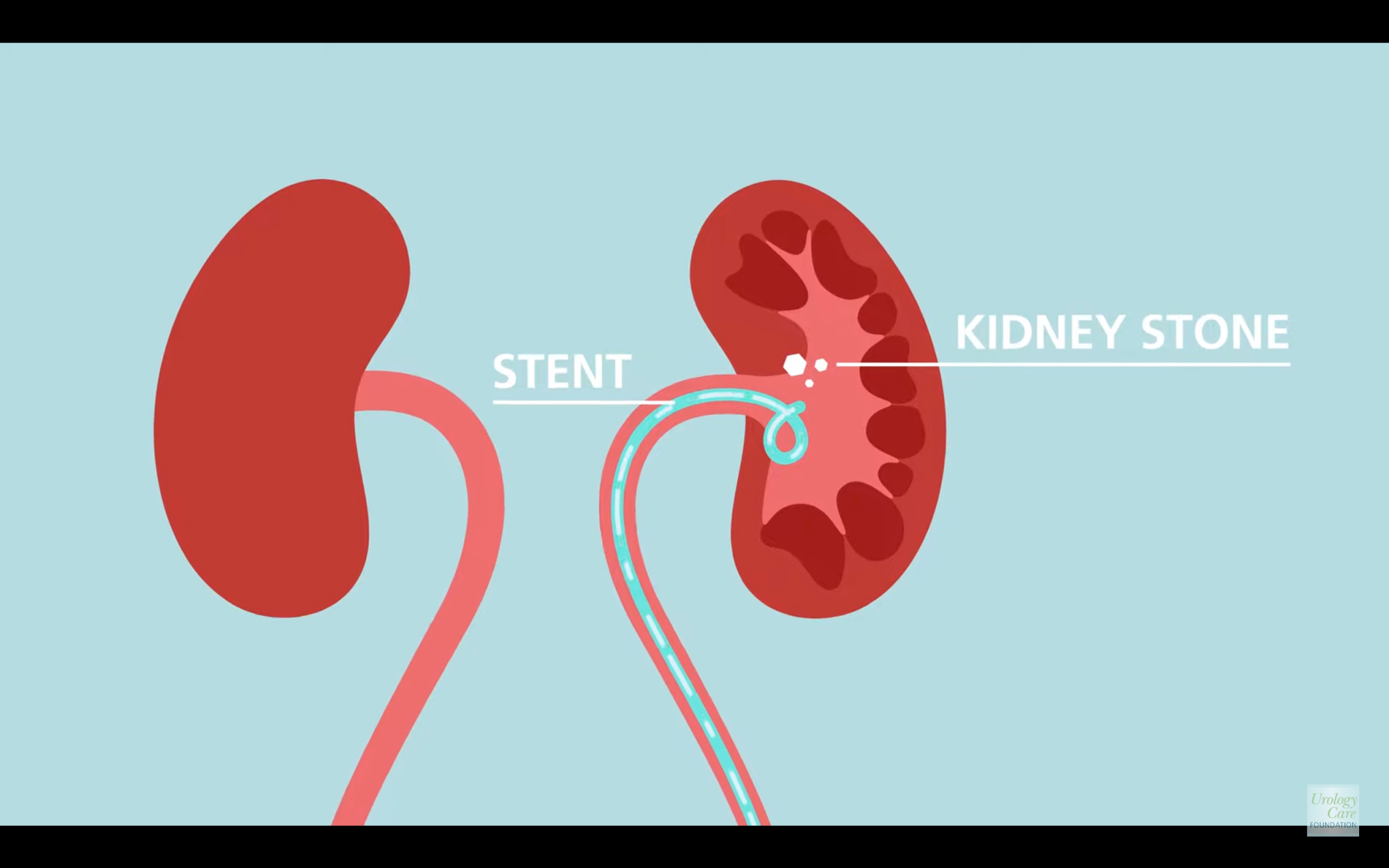 Kidney stones and ureteral stents: Credible patient resources | Dr ...